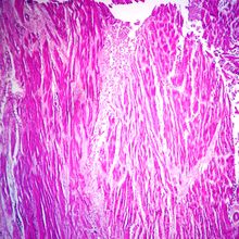 Myocardial Infarction, Sec. Microscope Slide | Carolina Biological Supply