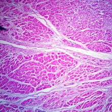 Myocardial Infarction, Microscope Slide | Carolina Biological Supply