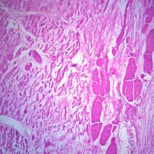 Human Myocardial Infarct, Old, sec. 7 µm, H&E Microscope Slide ...