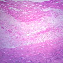 Human Atherosclerosis - Aorta, sec. 7 µm H&E Microscope Slide ...