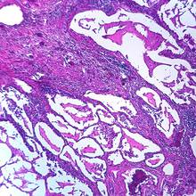 Human Pulmonary Edema, sec. 7 µm, H&E Microscope Slide | Carolina ...