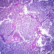 Lobar Pneumonia, Microscope Slide | Carolina Biological Supply