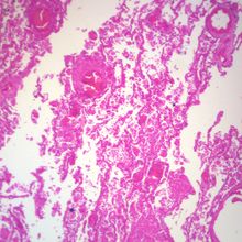 Human Tuberculosis, sec. 7 µm H&E Microscope Slide | Carolina ...