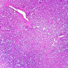 Human Liver with Hepatitis, sec. 7 µm H&E Microscope Slide | Carolina ...
