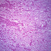 Chronic Pyelonephritis, Microscope Slide | Carolina Biological Supply