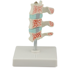 Altay® Human Advanced Osteoporosis Model | Carolina Biological Supply