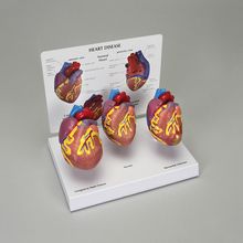 GPI Anatomicals® Human Heart Disease Model | Carolina Biological Supply