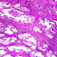 Benign Prostatic Hyperplasia, Microscope Slide | Carolina Biological Supply