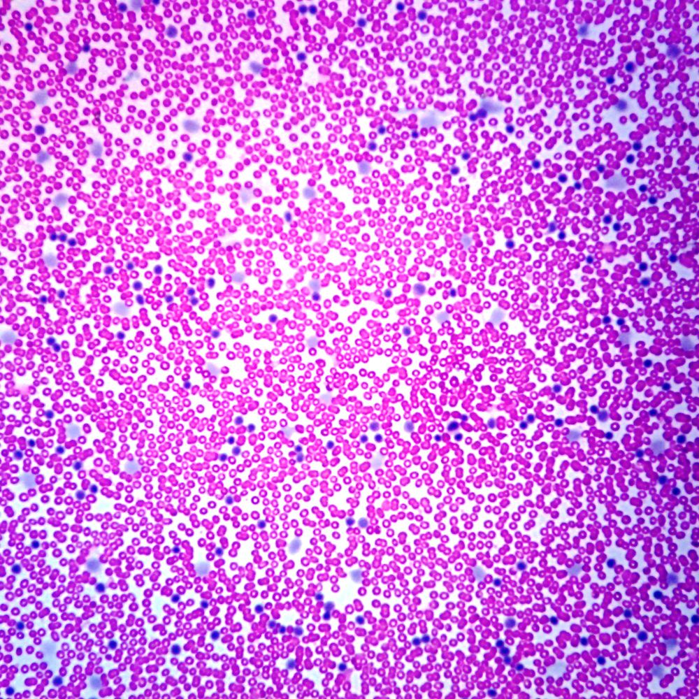 Human Chronic Lymphocytic Leukemia, Microscope Slide | Carolina ...