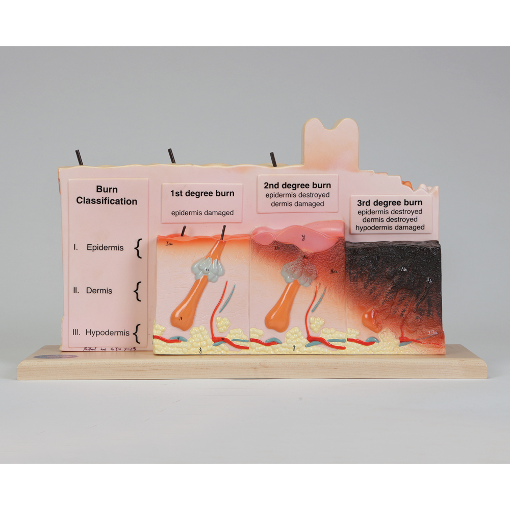 Human Skin with Burn Pathologies Model | Carolina.com