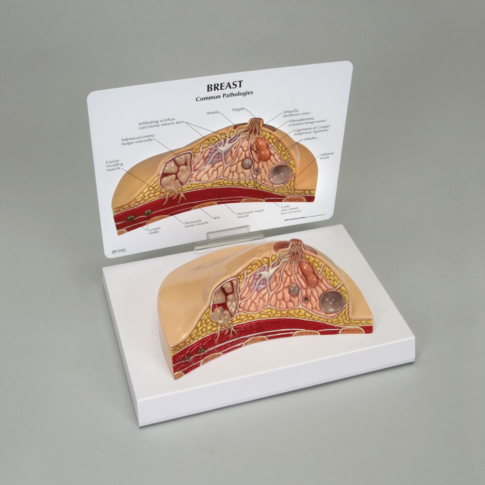 GPI Anatomicals® Human Breast Pathology Model | Carolina Biological Supply GPI Anatomicals® Human Breast Pathology Model | Carolina Biological Supply