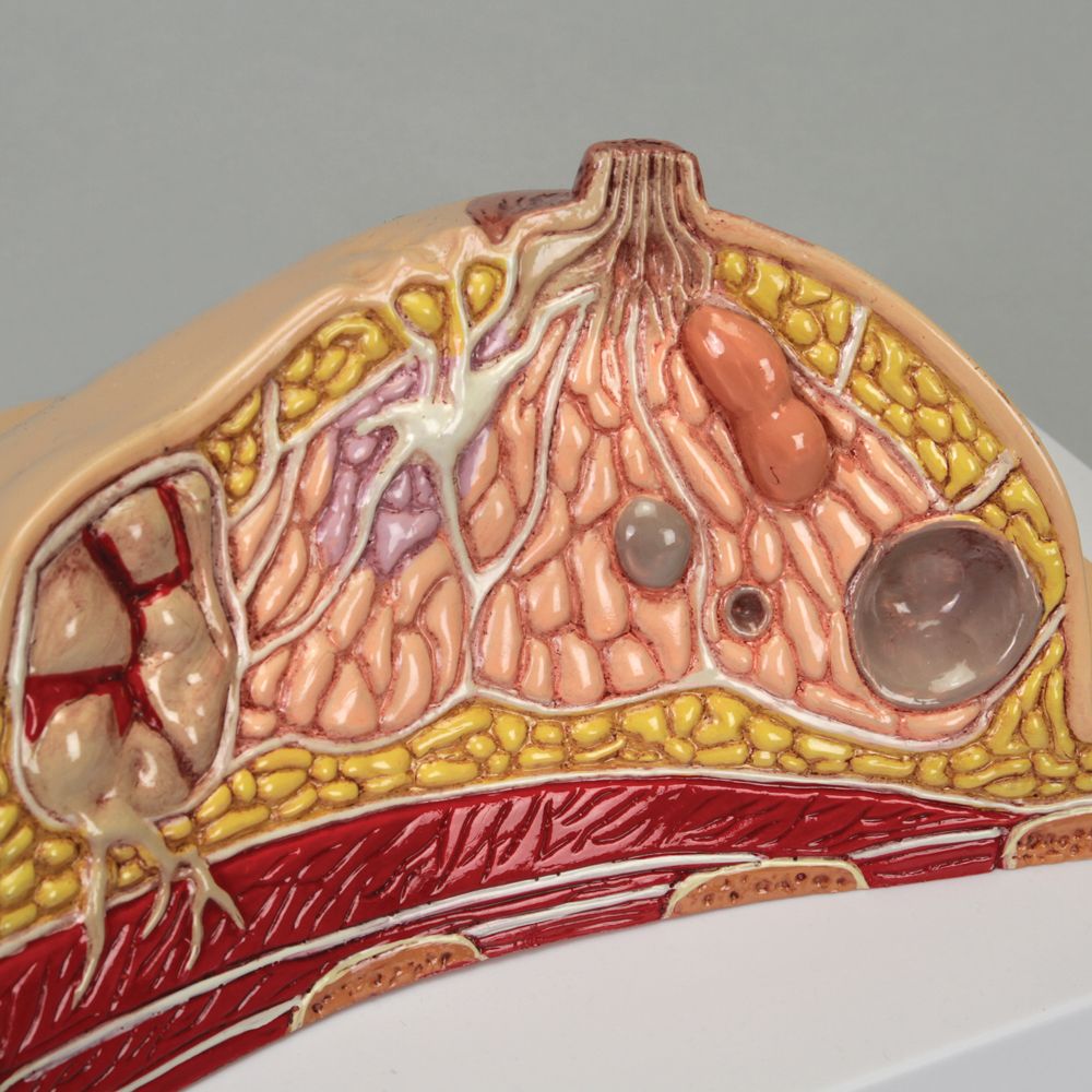 GPI Anatomicals® Human Breast Pathology Model | Carolina Biological Supply GPI Anatomicals® Human Breast Pathology Model | Carolina Biological Supply