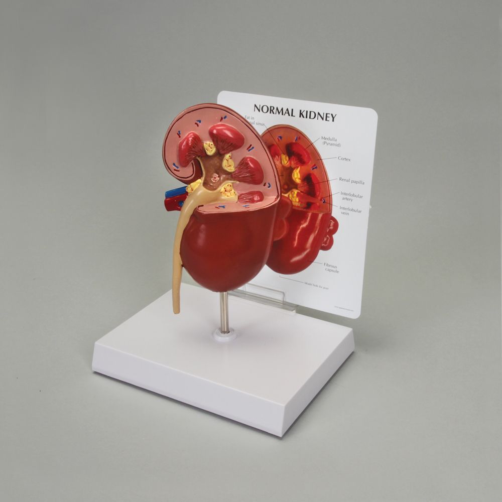 GPI Anatomicals® Human Kidney Pathology Model | Carolina Biological Supply