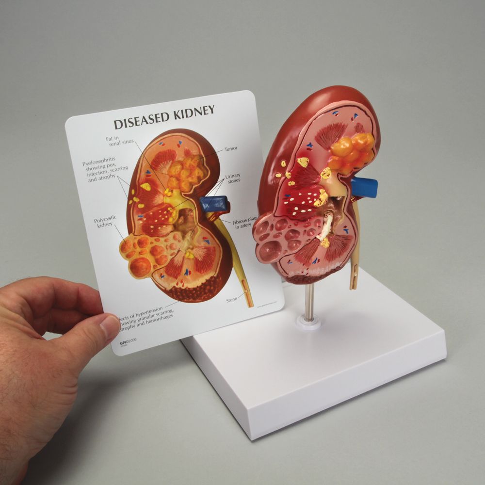 GPI Anatomicals® Human Kidney Pathology Model | Carolina Biological Supply