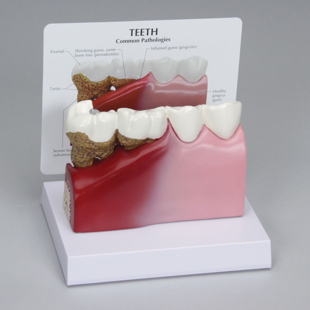 GPI Anatomicals® Human Teeth Pathology Model | Carolina Biological Supply