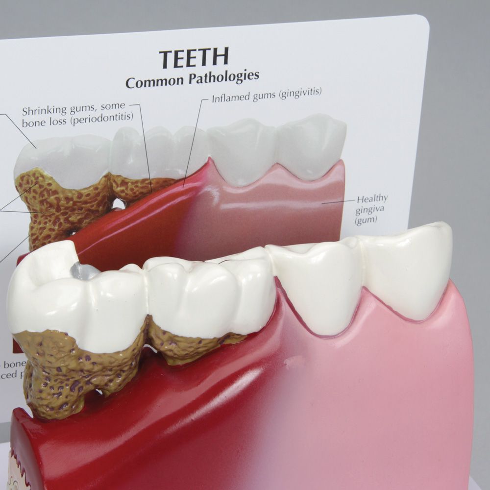 GPI Anatomicals® Human Teeth Pathology Model | Carolina Biological Supply