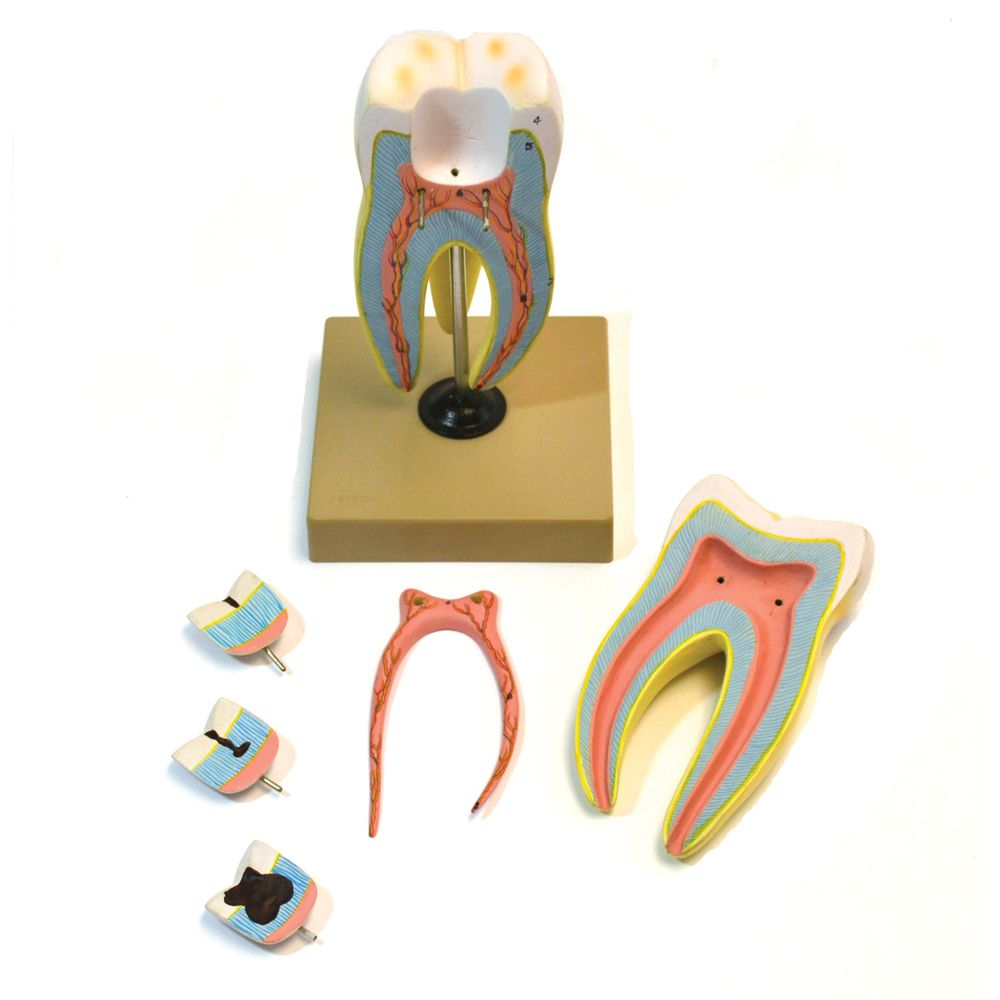 Eisco® Human Upper Triple Root Molar with Interchangeable Cavities ...