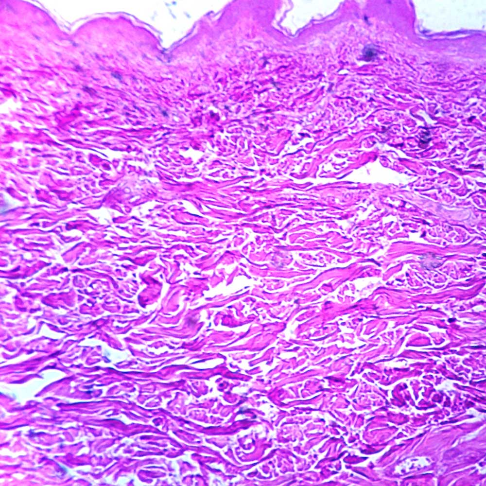 Rocky Mountain Spotted Fever, Skin, section Microscope Slide | Carolina ...