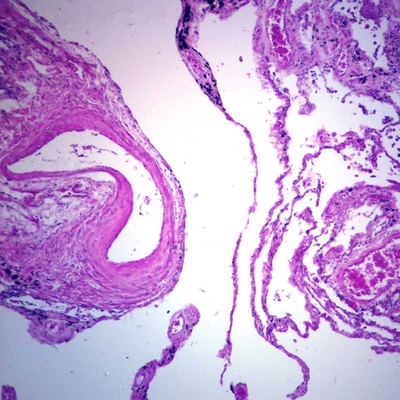 Human Anthracosis of Lung, sec. 7 µm H&E Microscope Slide | Carolina ...